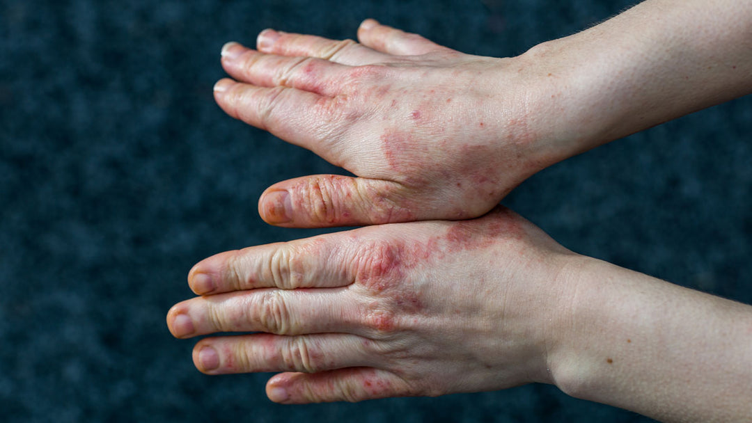 Physician – Tagged "do radiation burns ever heal" – Rejûvaskin