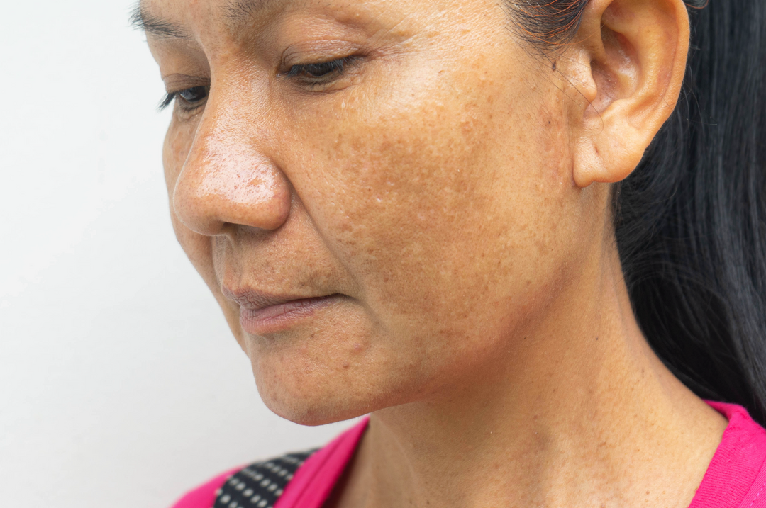 What Are The Types of Hyperpigmentation? – Rejûvaskin