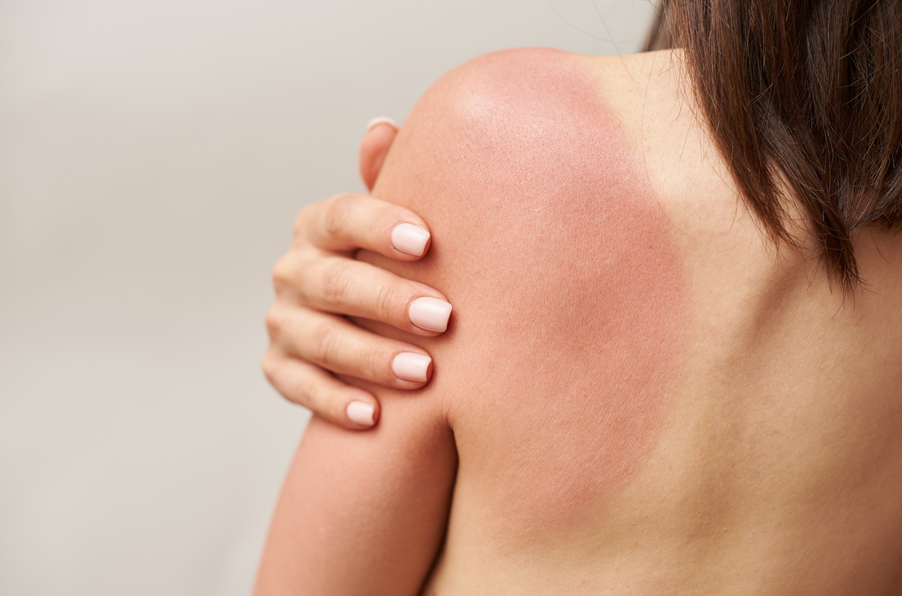 How To Treat A Sunburn: What Actually Works? – Rejûvaskin