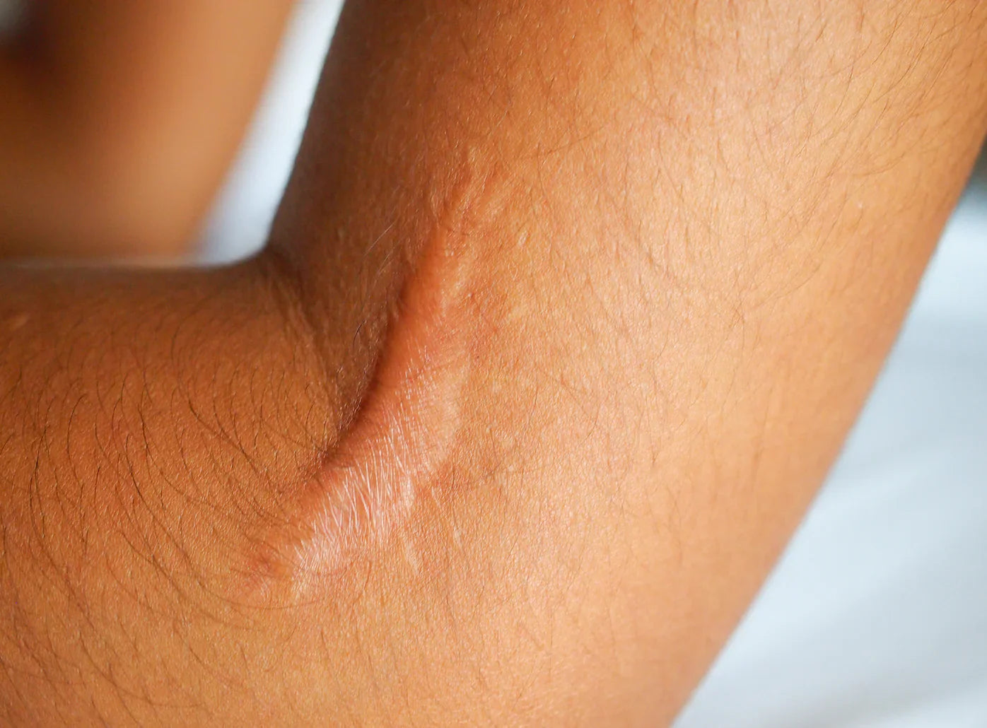 Understanding Keloid Scars: Causes, Prevention, and Treatment Options ...