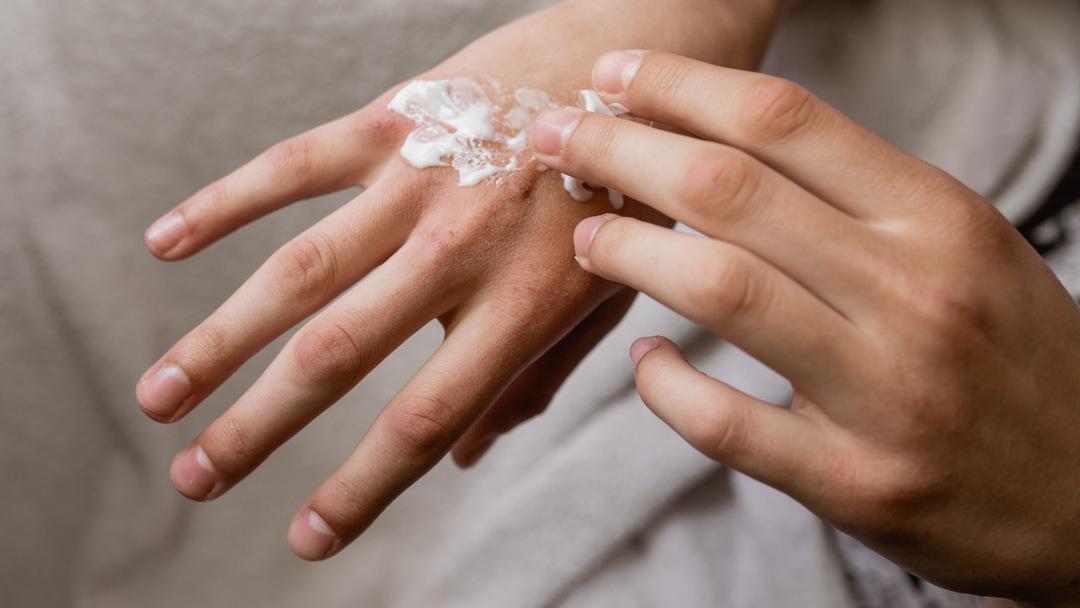 Xerotic (Winter) Eczema: Prevention and Care – Rejûvaskin