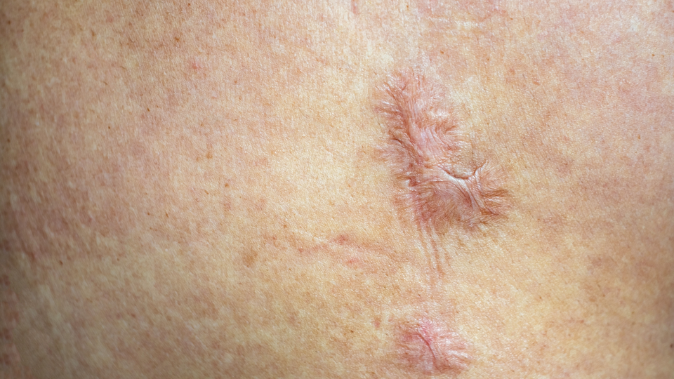 Why Do My Scars Turn Dark? The Basics Behind Scar Discoloration ...