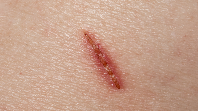 Scar Maturation: Why Scars Change Over Time and How Rejûvaskin Support