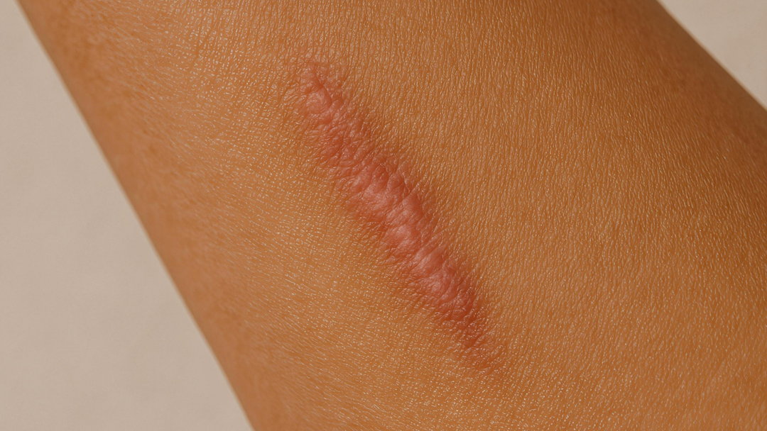 Keloids vs. Hypertrophic Scars: What’s the Difference & Why It Matters ...
