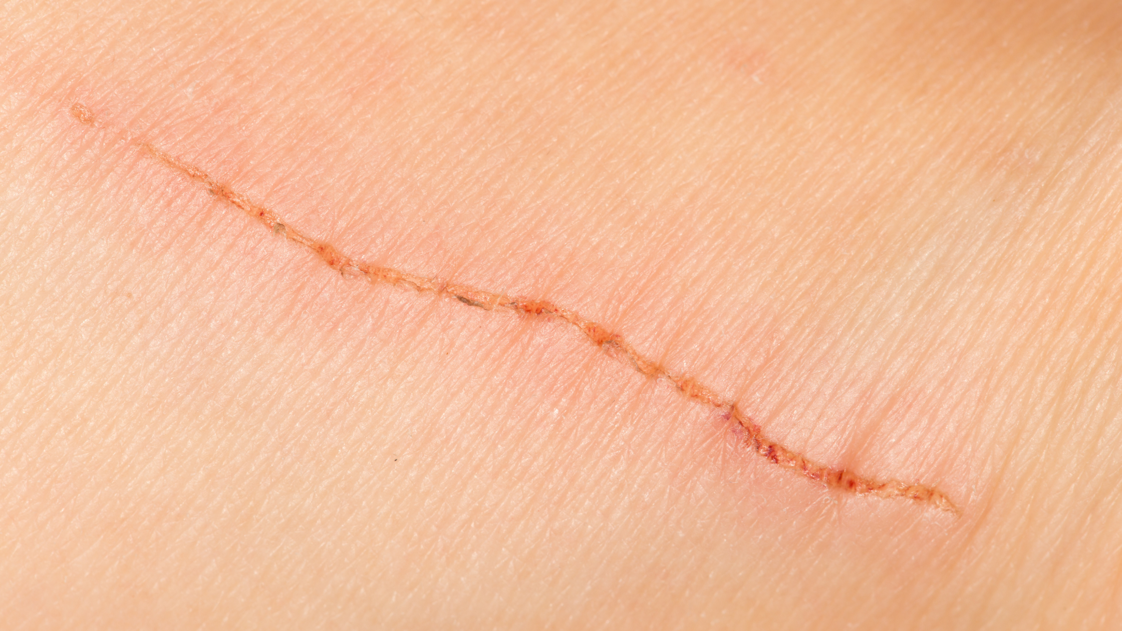 The First 30 Days After Surgery: Your Complete Scar Care Timeline ...