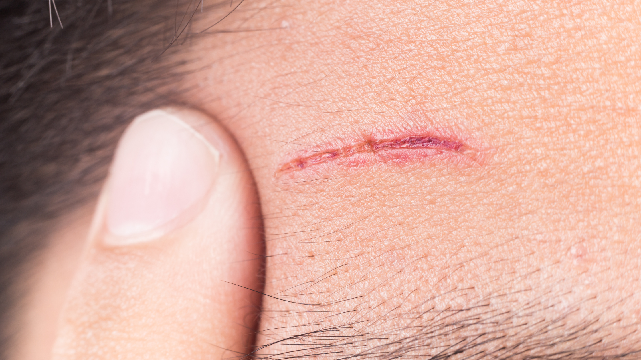 What Is Good for Scars on the Face? – Rejûvaskin