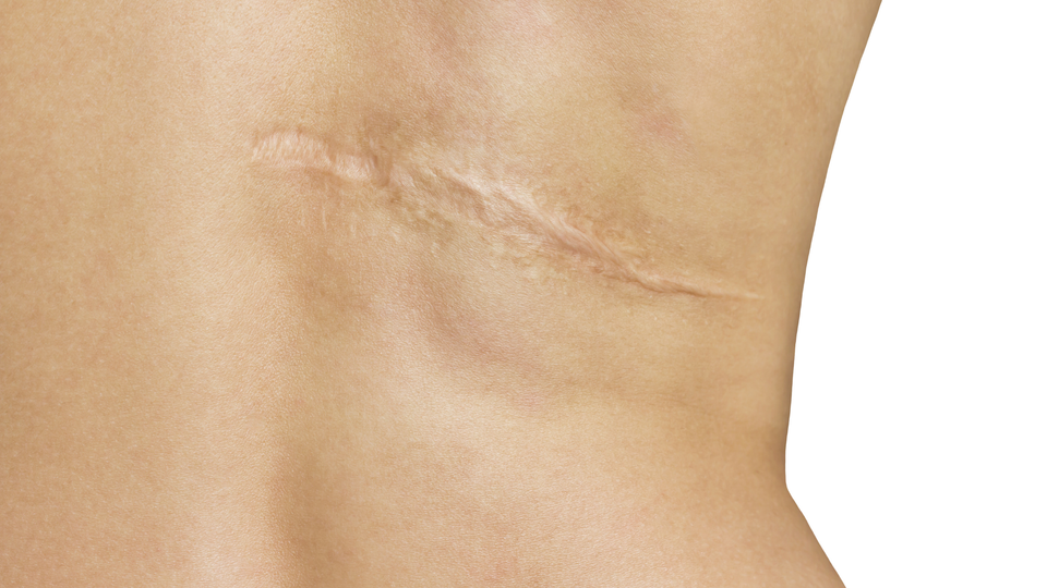 Will My Burn Leave a Scar? A Guide to Burn Types and Scar Care – Rejûvaskin