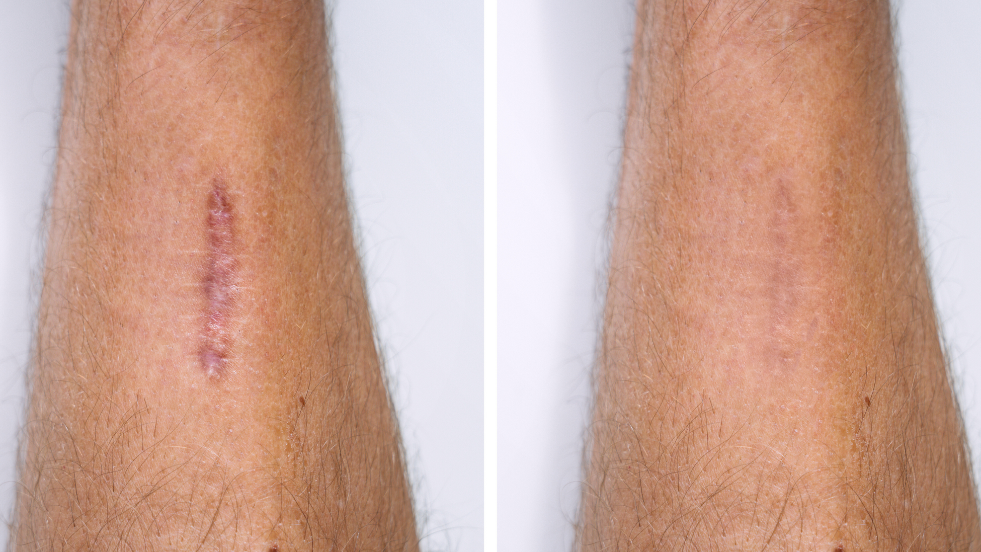 Surgical Scar Healing Stages: How to Fade Scars from Start to Finish ...