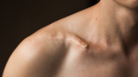 Why Do My Scars Turn Dark? The Basics Behind Scar Discoloration ...