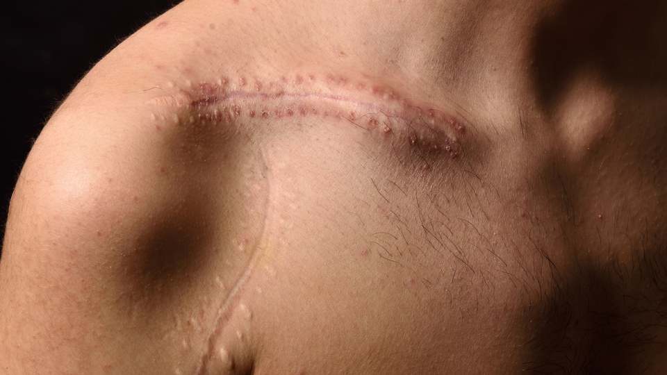 Why Do My Scars Turn Dark? The Basics Behind Scar Discoloration ...