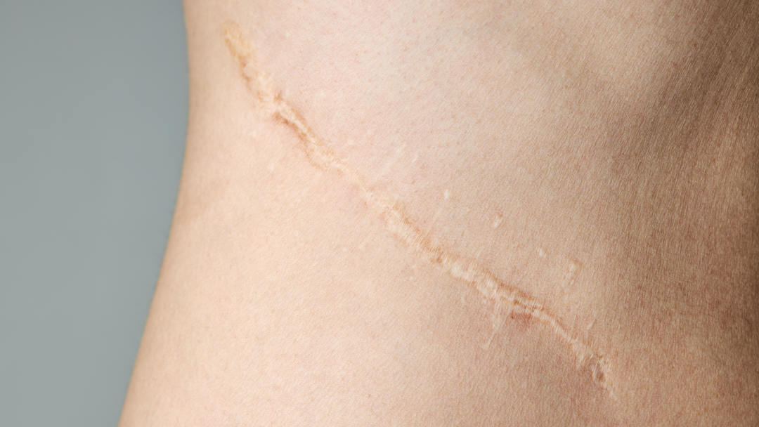 Hyperpigmentation or Hypertrophic? How to Tell What Stage Your Scar Is – Rejûvaskin