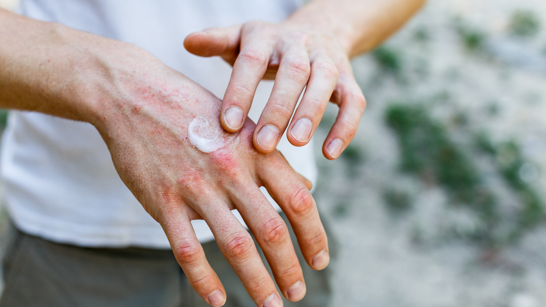 Is Paraffin Bad for Eczema? – Rejûvaskin