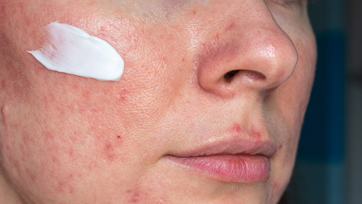 Long-Term vs. Short-Term Skin Barrier Damage: Effects, Recovery Tips ...