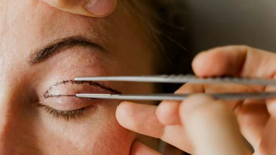 Healing Blepharoplasty Scars: Is Silicone Scar Gel Safe Around The Eye ...