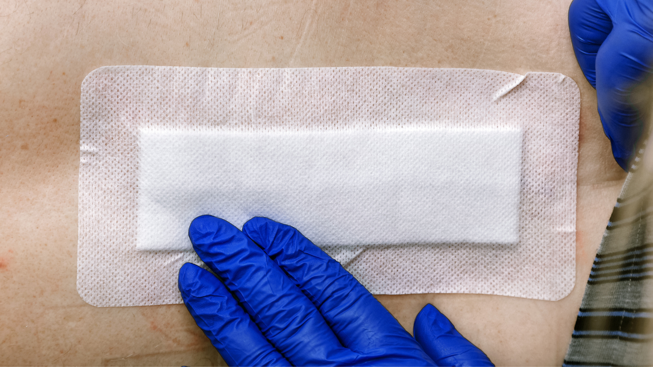 Skin Grafting 101: How Silicone Gel and Sheeting Enhance Healing ...