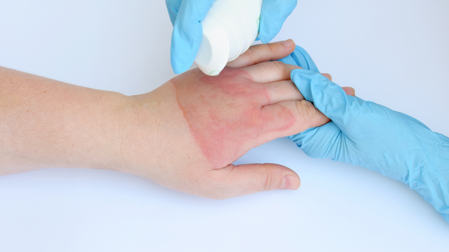 Will My Burn Leave a Scar? A Guide to Burn Types and Scar Care – Rejûvaskin