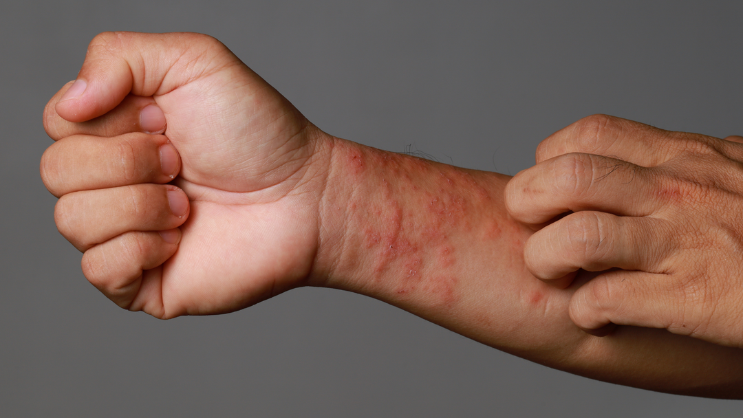 What Does Eczema Look Like? An In-Depth Guide – Rejûvaskin