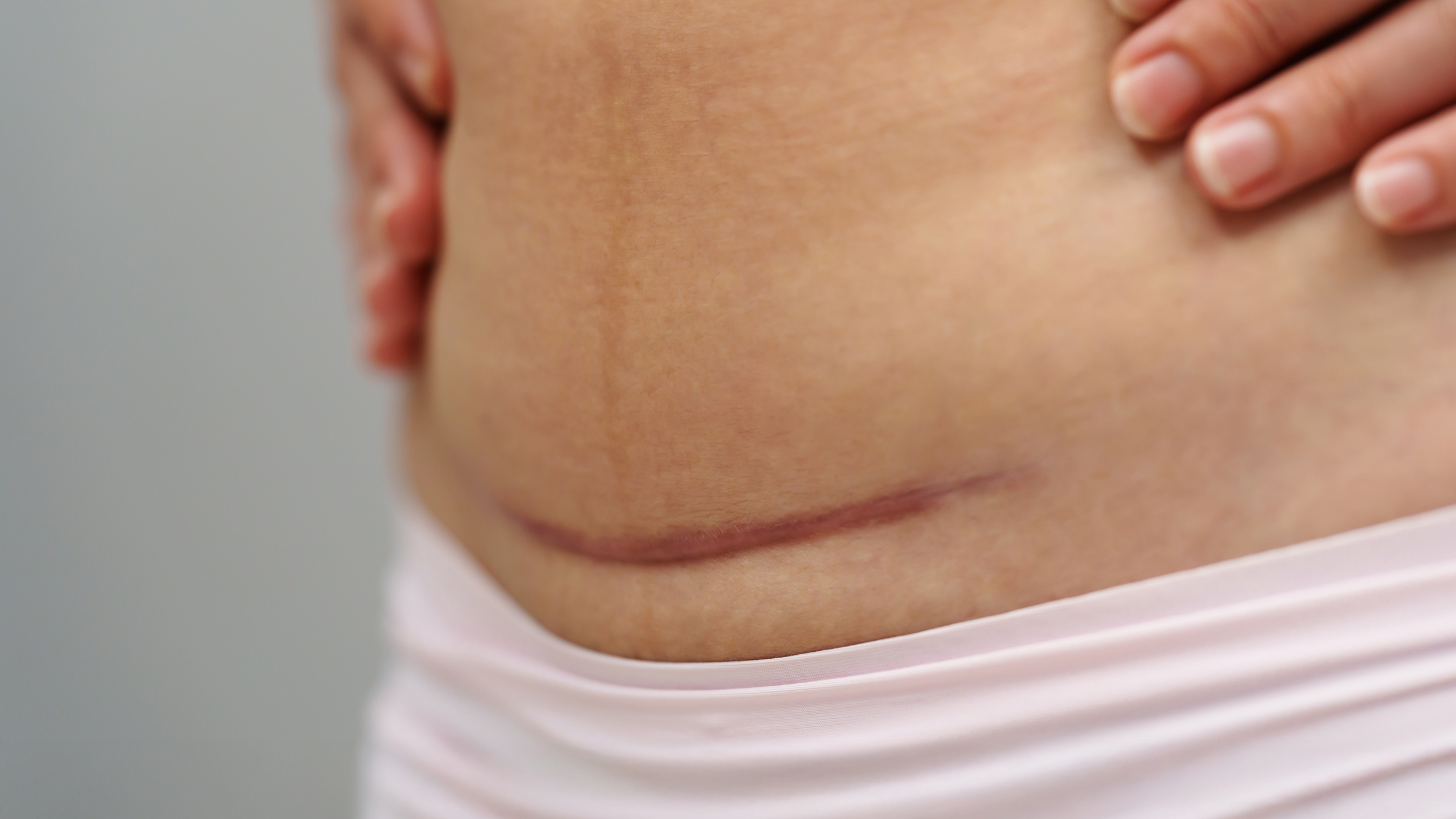 National Scar Appreciation Day: Understanding Scar Formation and Heali ...