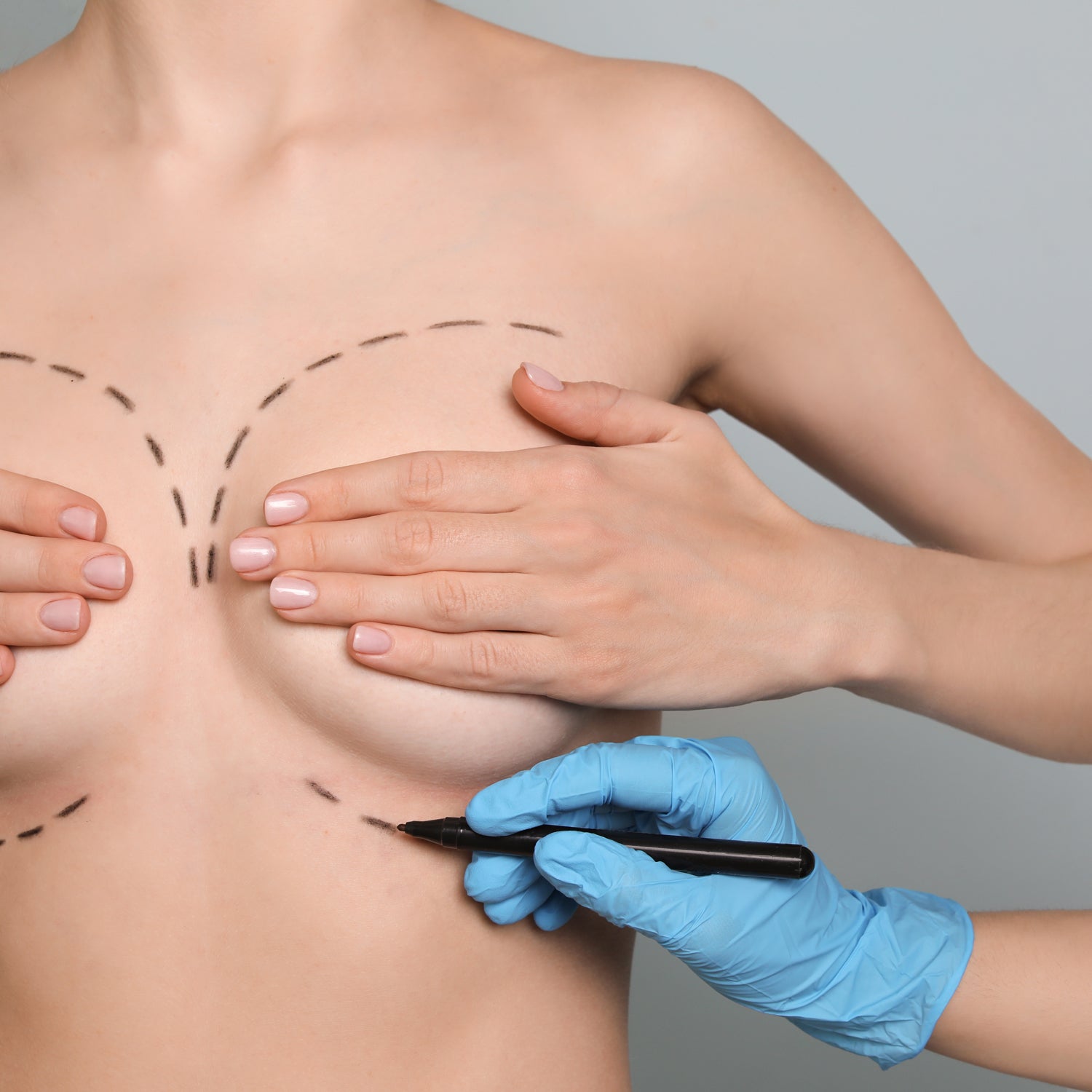 Physician-Recommended Silicone Scar Management For Breast Procedure ...