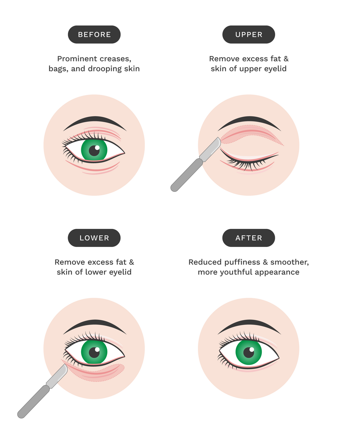 Post-Op Blepharoplasty Recovery - Reduce Visible Scars With Rejûvaskin ...