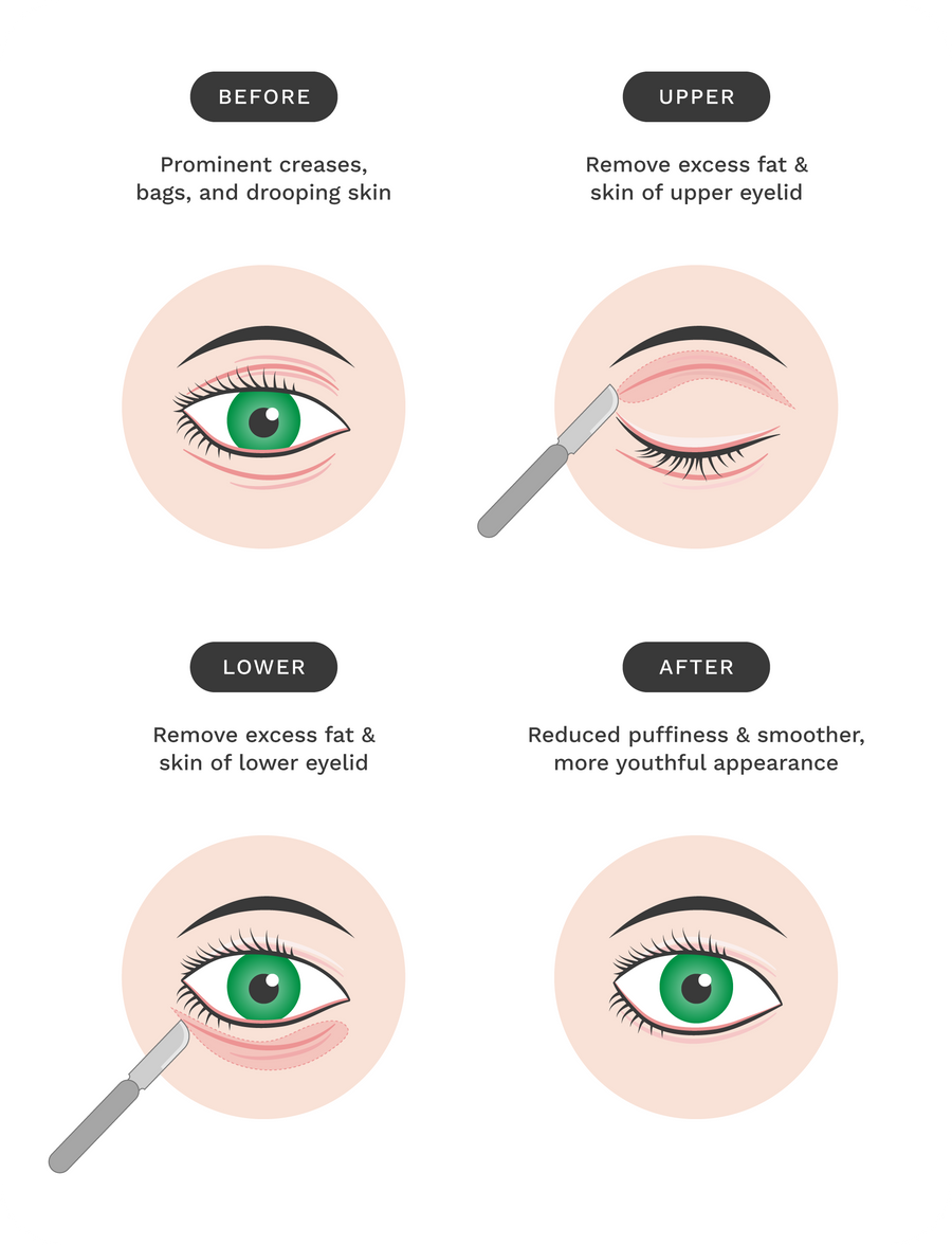 Post-Op Blepharoplasty Recovery - Reduce Visible Scars With Rejûvaskin ...
