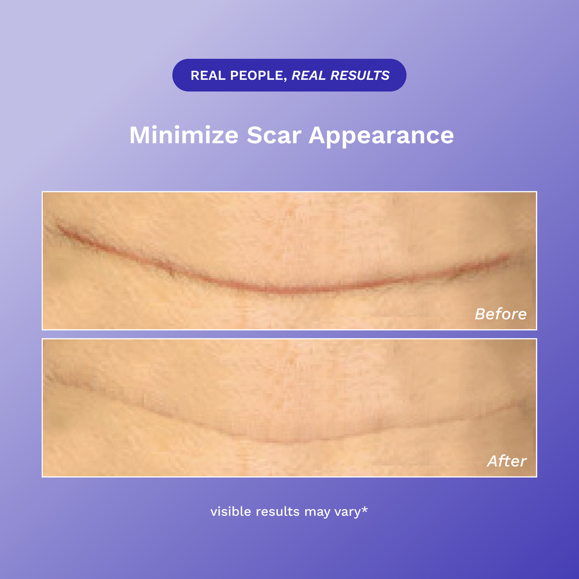 Rejûvaskin Scar Fx Silicone Sheeting - Reduce Scar Appearance