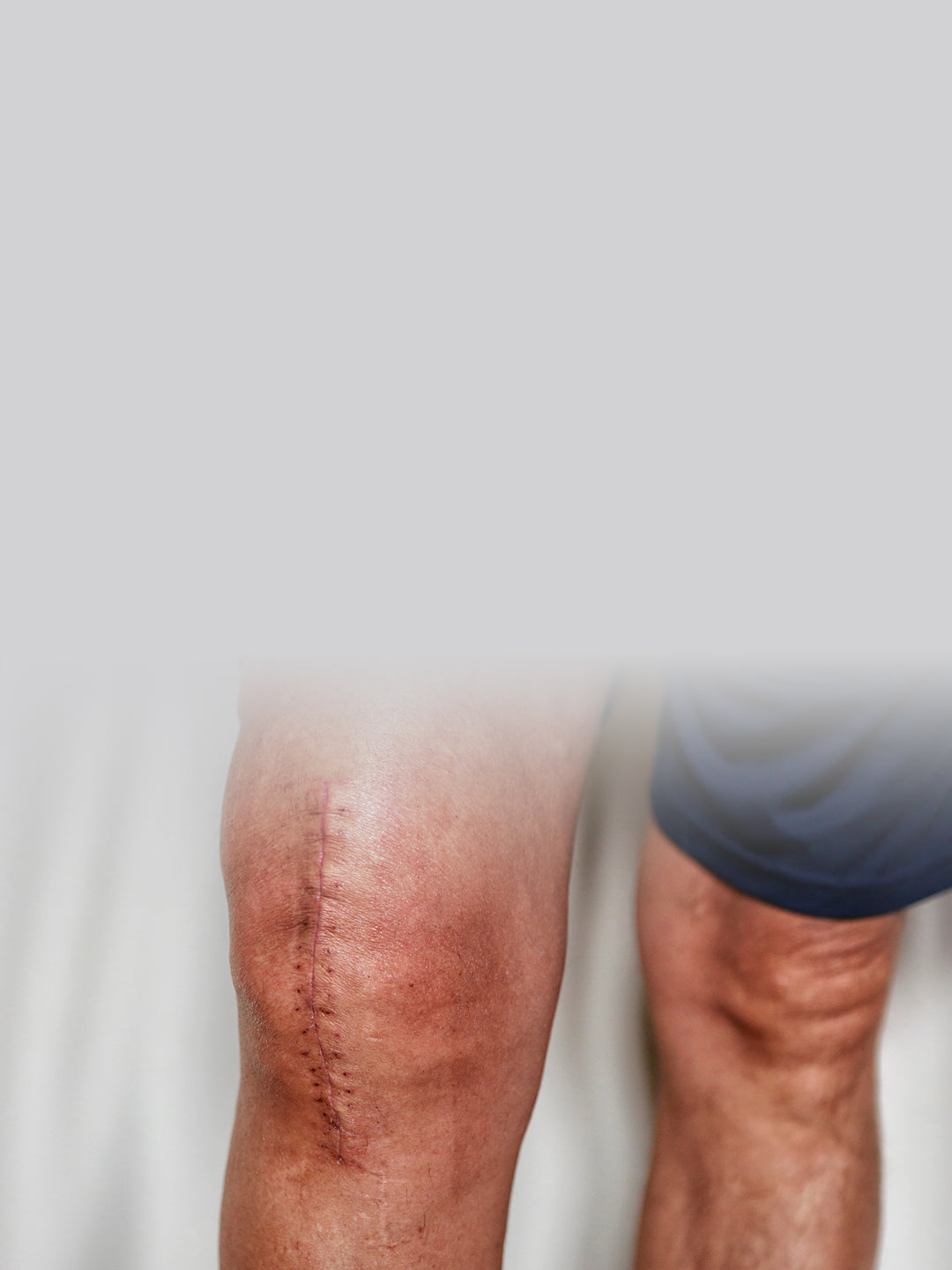 Manage Post-Op Scarring For Orthopedic Procedures | Rejûvaskin
