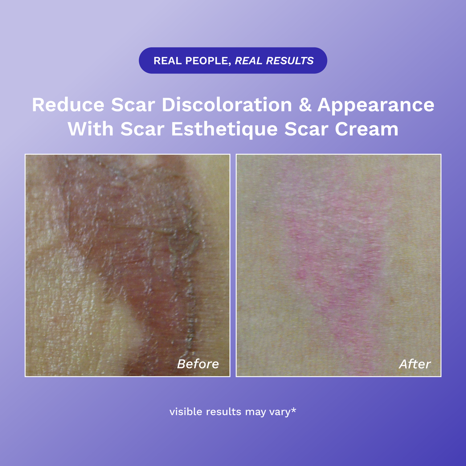Scar Esthetique: Silicone Scar Cream for Discoloration & Old Scars ...