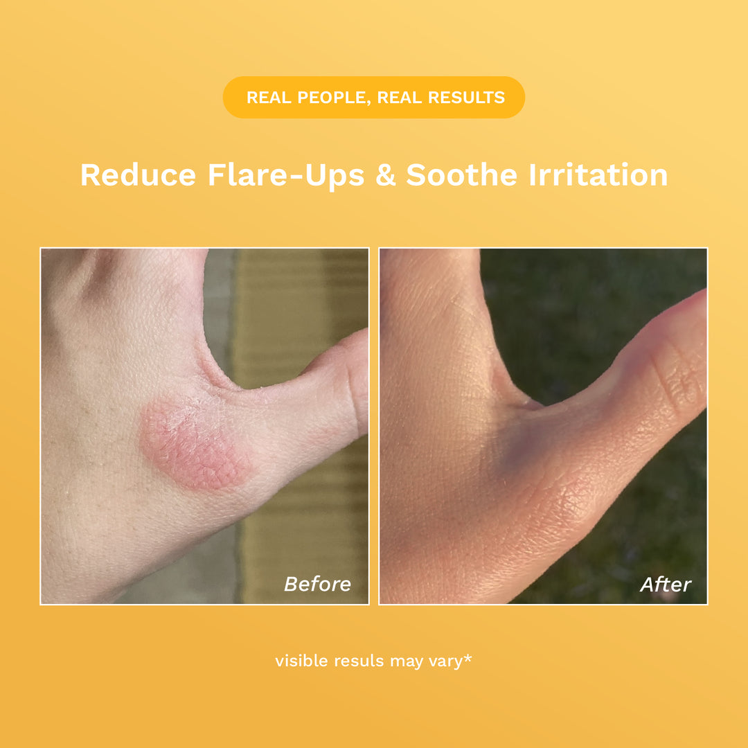 Rejuvaskin Skin Recovery Cream for Radiation Relief - Rejuvaskin ...