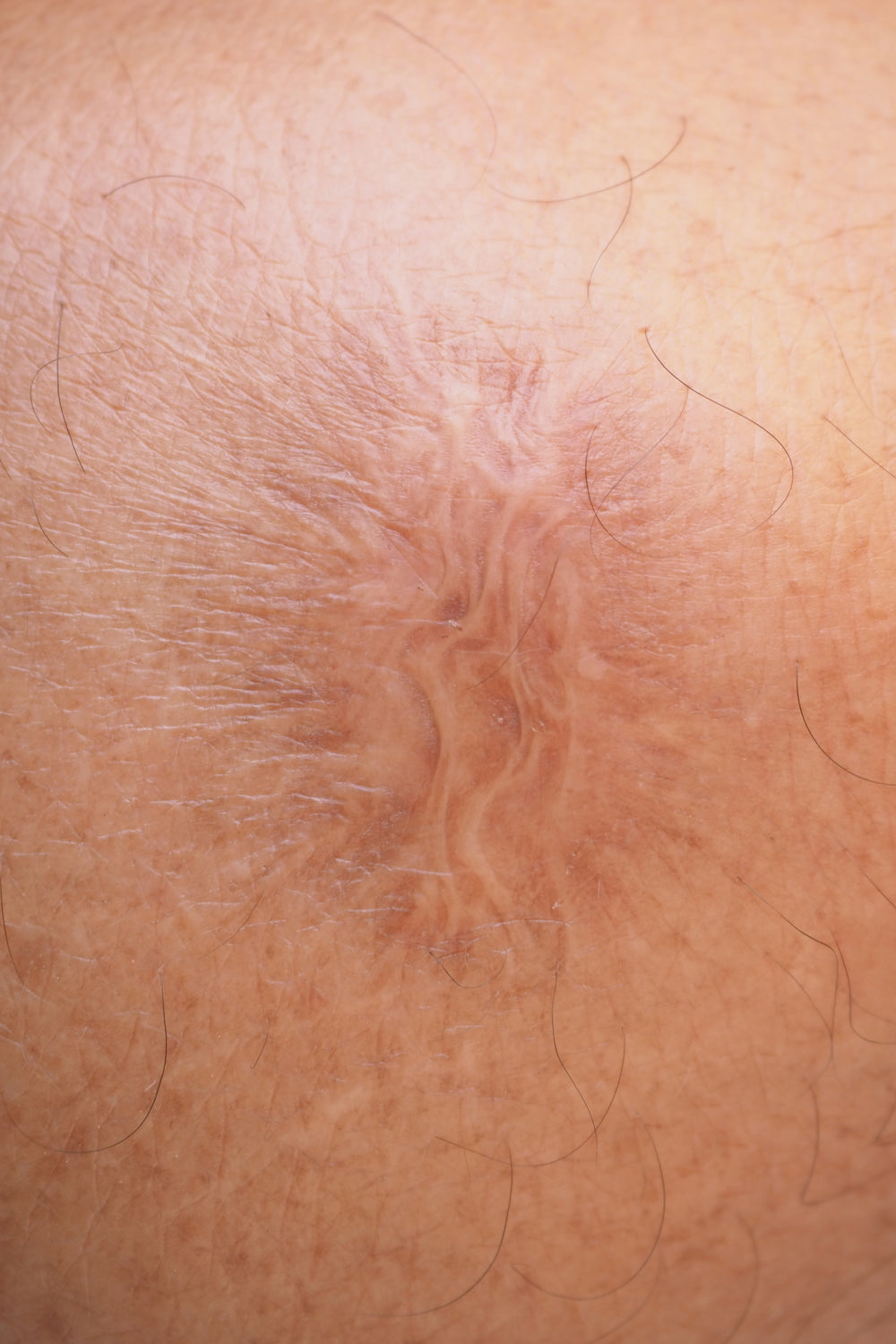 Rejûvaskin's Scar Guide: Types Of Scars